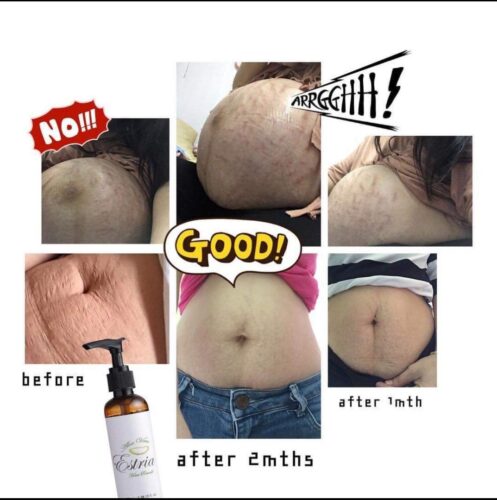 Estria Oil + Free Gift 妊娠油+赠品